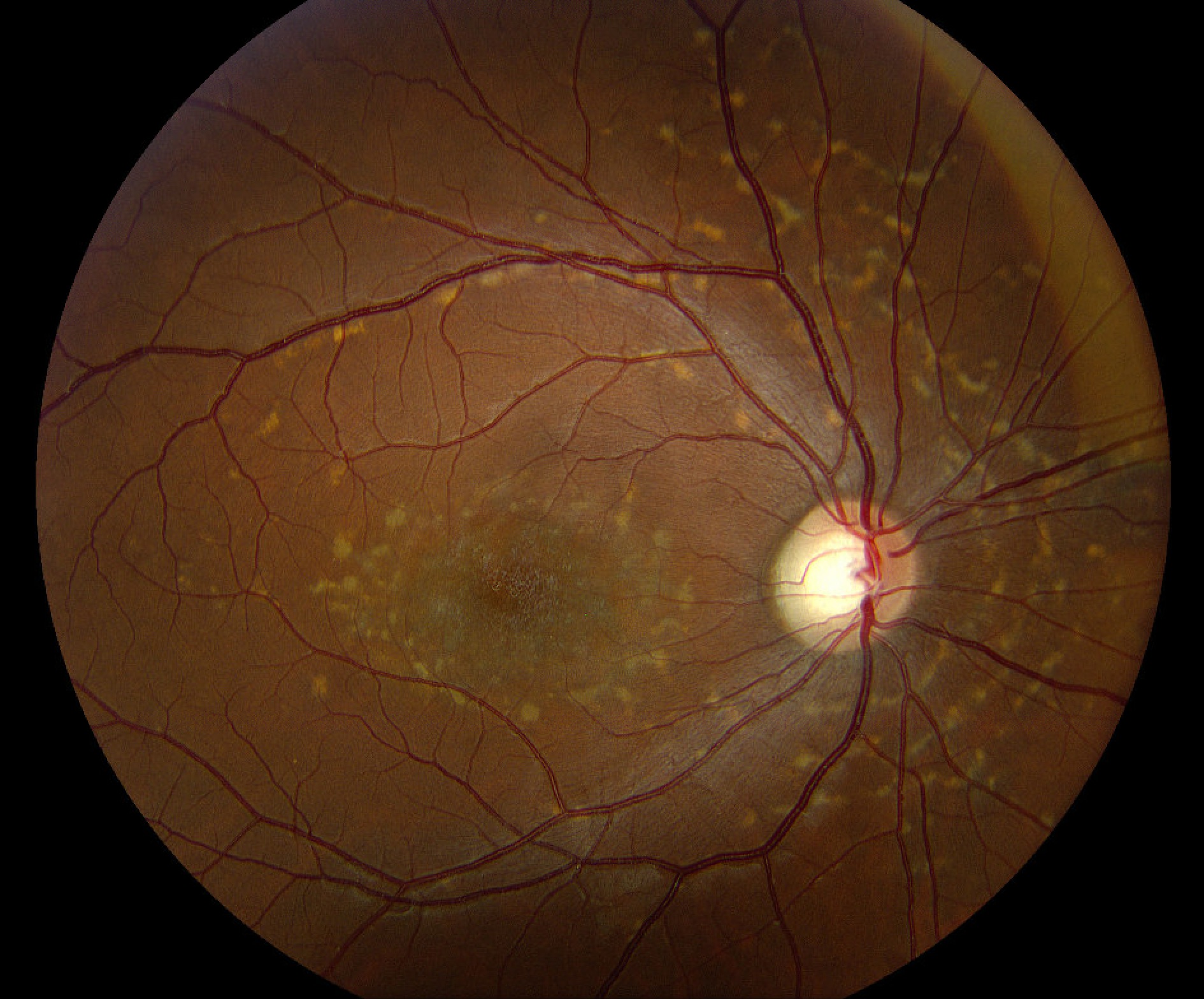 Atlas Entry - Stargardt disease