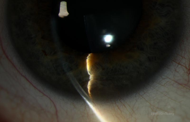 Iris pigment epithelialcysts. EyeRounds.org Online Ophthalmic Atlas