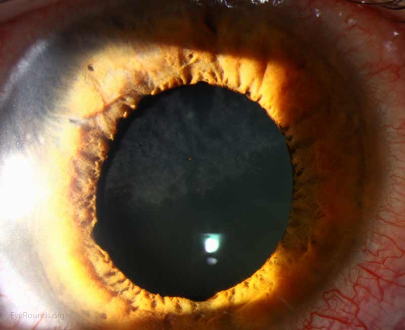 Traumatic iris sphincter tears