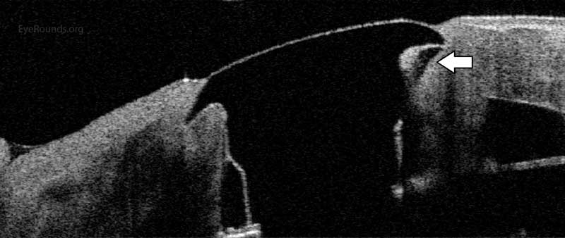 Corneal melt around Boston type I keratoprosthesis