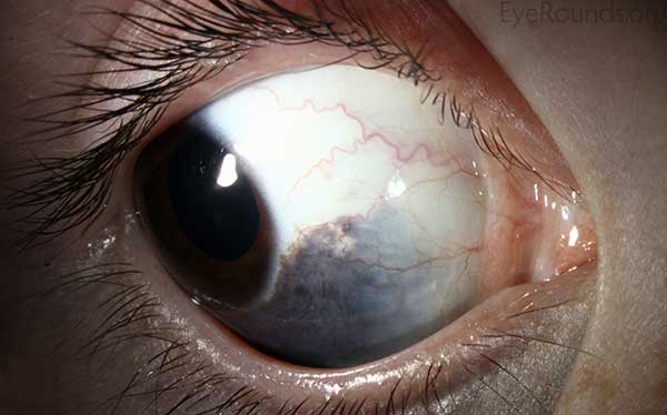 Oculodermal melanocytosis (nevus of Ota)