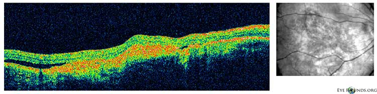 Choroidal osteoma: Online Atlas of Ophthalmology: The University of ...