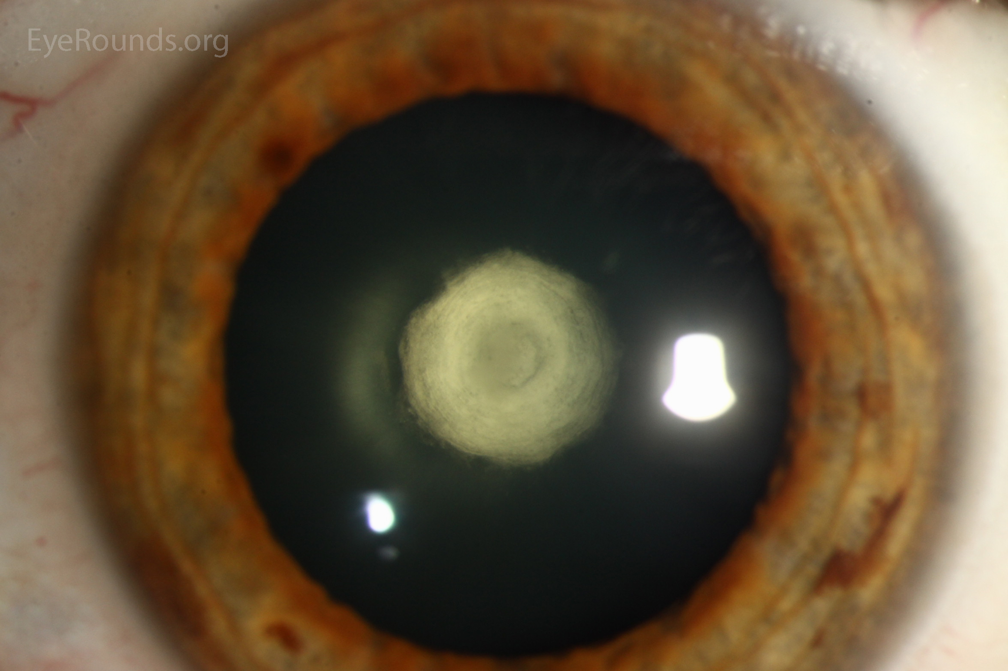 Atlas Entry Posterior Polar Cataract Atlas Entry Posterior Polar Cataract