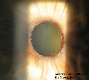 Pseudoexfoliation syndrome