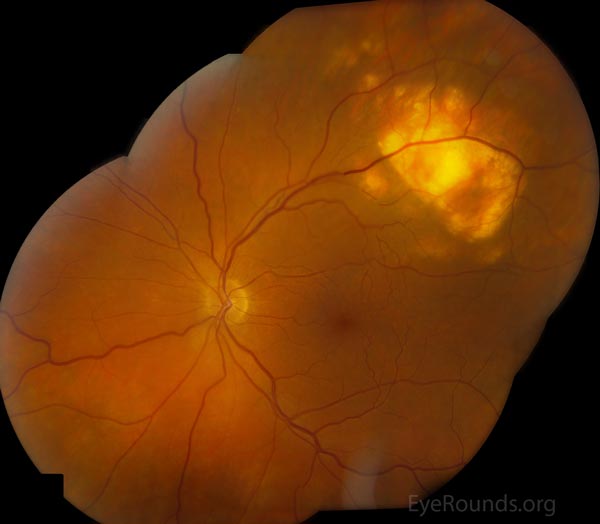 Idiopathic sclerochoroidal calcification