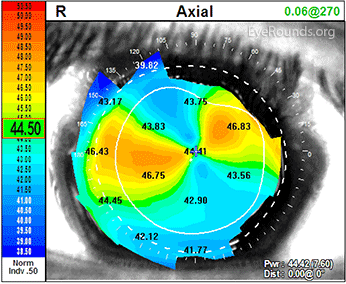 Terrien Marginal Degeneration : The University of Iowa, Ophthalmology