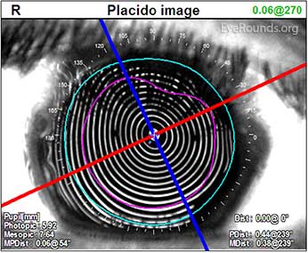 Terrien Marginal Degeneration : The University of Iowa, Ophthalmology