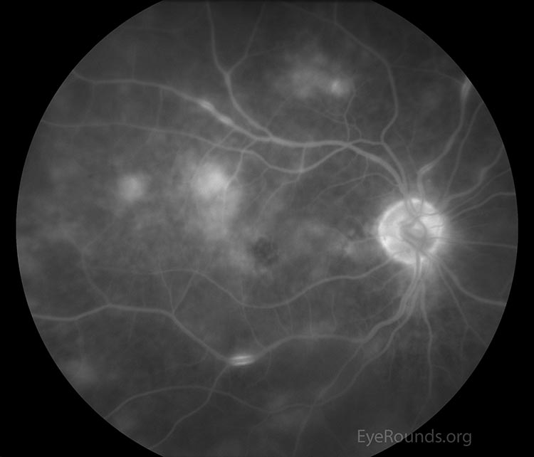 Vascular sheathing in idiopathic retinal vasculitis