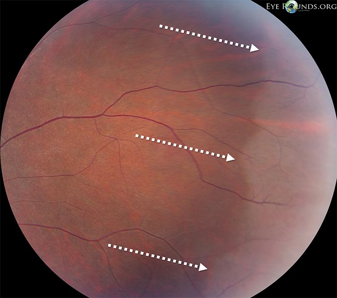 White Without Pressure (WWP)