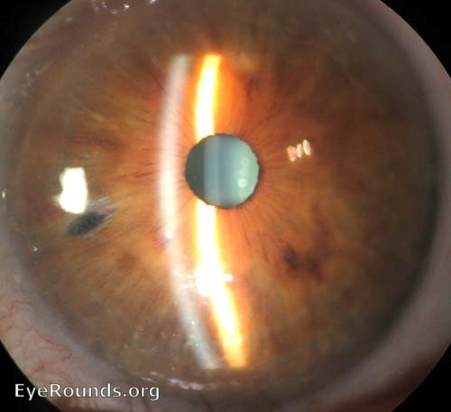 acute angle closure glaucoma. EyeRounds.org: Online Ophthalmic Atlas