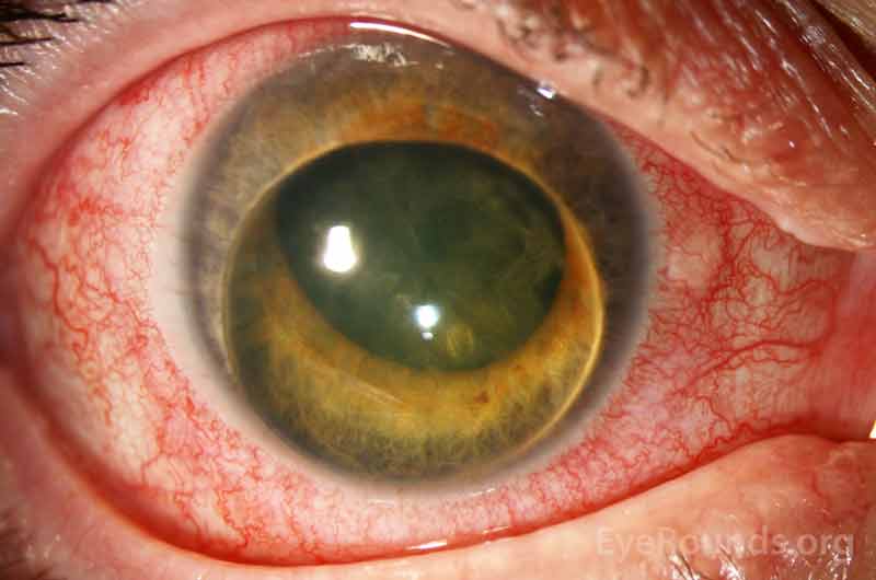 Phacomorphic Angle Closure and Anterior Lens Dislocation due to ...