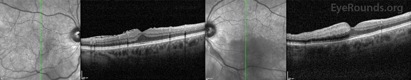 Branch Retinal ArteryOcclusion, BRAO