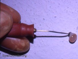 Morgagnian hypermature cataract: extracted intracapsularly with the ...