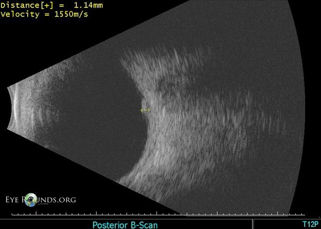 Carcinosarcoma choroidal metastasis