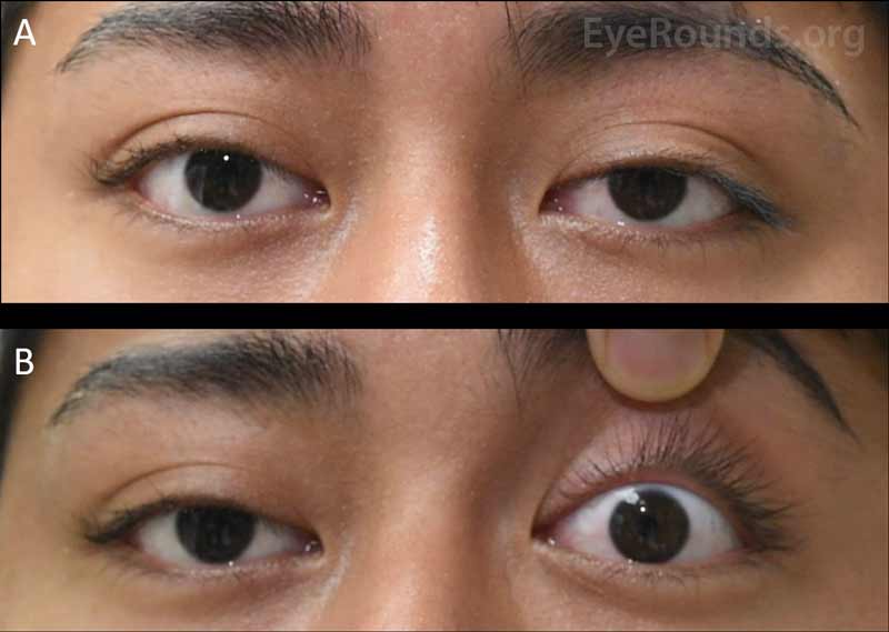 Atlas Entry - The Effect of Hering's Law in Ptosis