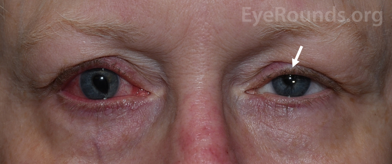 Atlas Entry - The Effect of Hering's Law in Ptosis