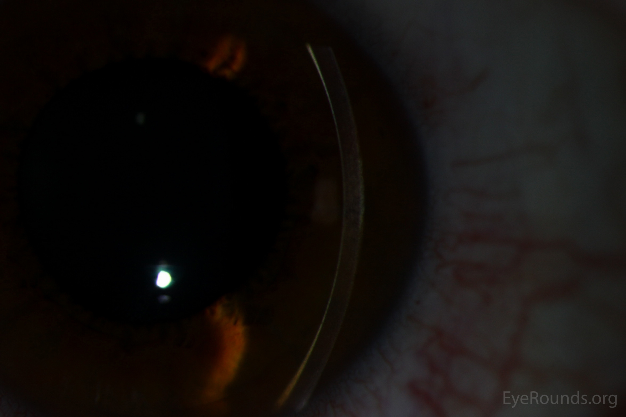 Atlas Entry - Kayser-Fleischer Ring in Wilson's Disease