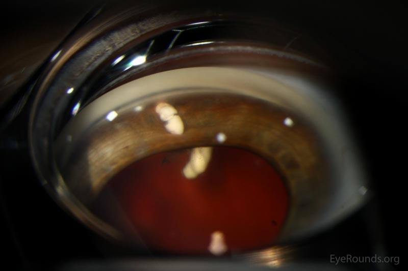 Transiridal Ozurdex Complication