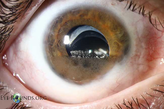 Retained perfluorocarbon liquid in the anterior chamber