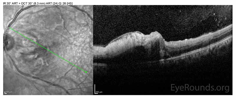 Purtscher Retinopathy