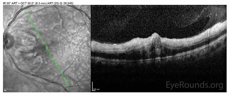 Purtscher Retinopathy