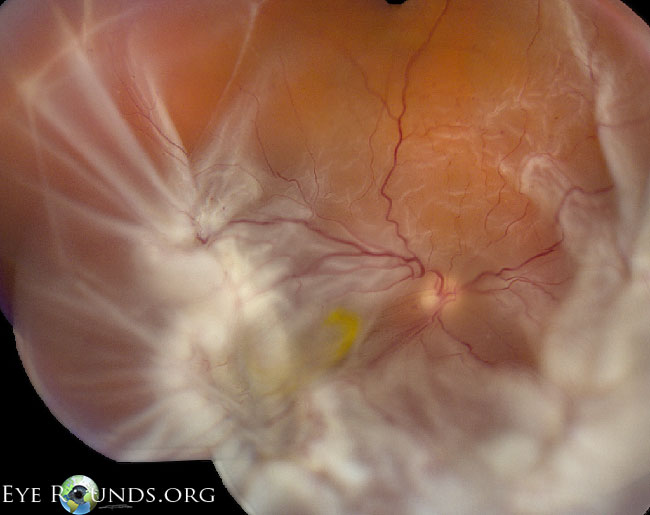 Retinal detachment with proliferative vitreoretinopathy