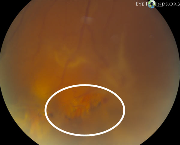 Retinal Breaks/Holes with Proliferative Vitreoretinopathy and Chronic ...