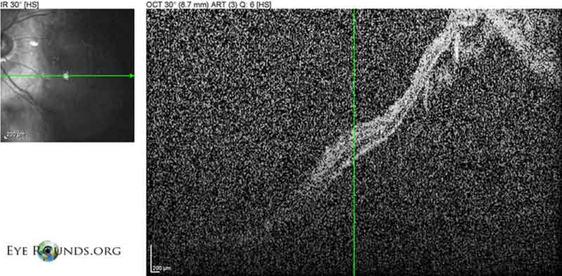 Rhegmatogenous Retinal Detachment, Macula-Off: The University of Iowa ...