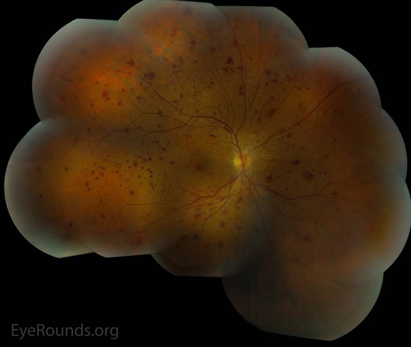 Radiation retinopathy