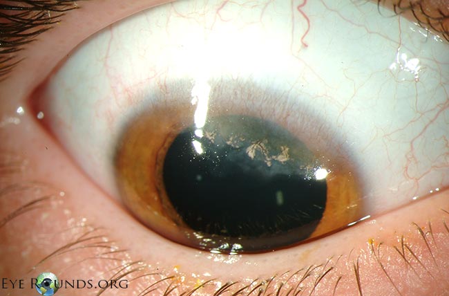 Terrien Marginal Degeneration : The University of Iowa, Ophthalmology