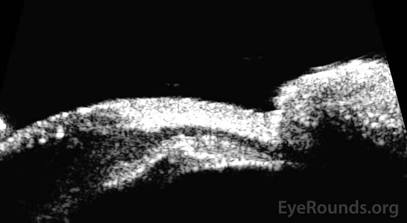 Angle recession and cyclodialysis after blunt trauma : The University ...