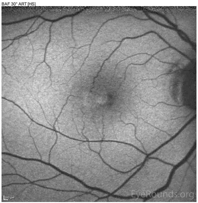 Idiopathic juxtafoveal telangiectasia