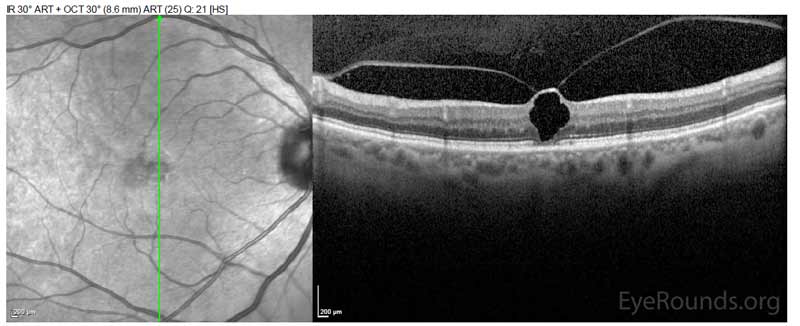 Idiopathic juxtafoveal telangiectasia