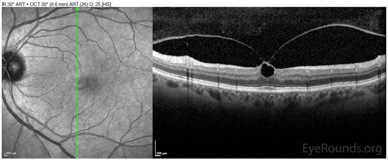 Idiopathic juxtafoveal telangiectasia