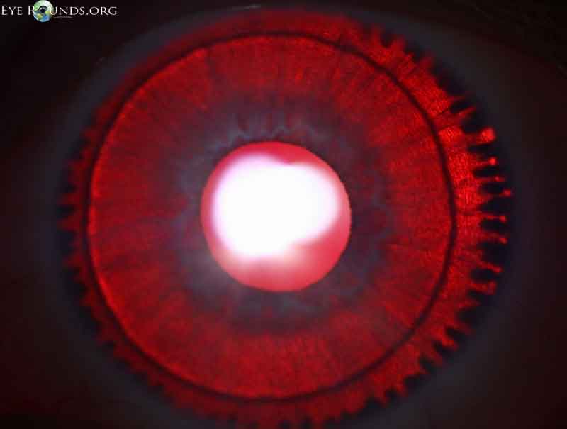 Oculocutaneous albinism :: The University of Iowa, Ophthalmology