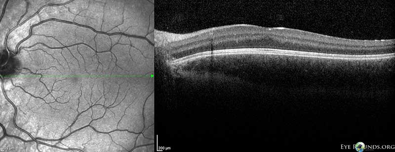 Oculocutaneous albinism :: The University of Iowa, Ophthalmology