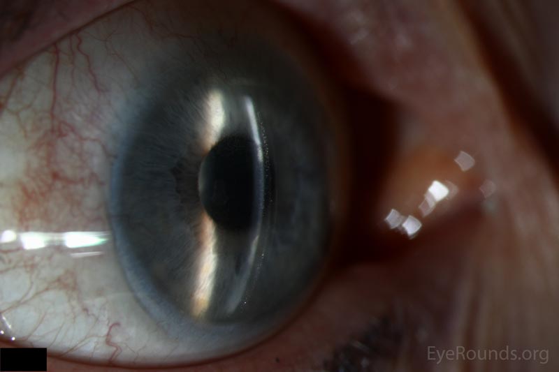 Appropriate Scleral Lens Sagittal Depth