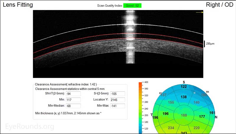 Appropriate Scleral Lens Sagittal Depth
