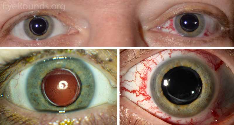 Exophthalmos secondary to a carotid cavernous fistula
