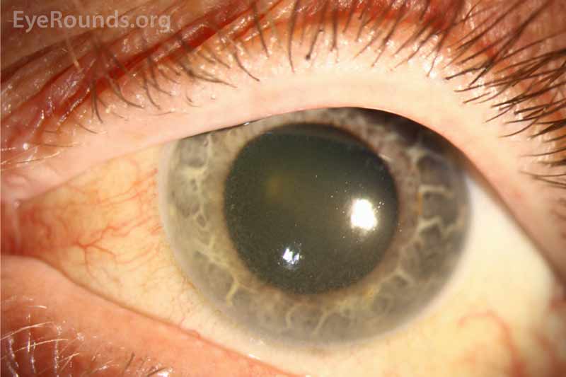 Corneal and lenticular pigmentation from long-term chlorpromazine use ...