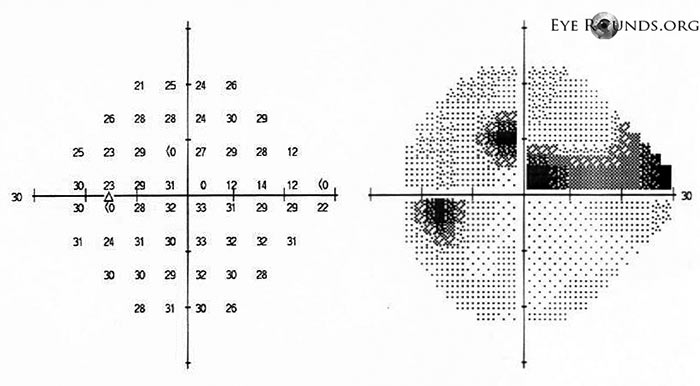 Optic Disc Notch and Retinal Nerve Fiber Layer Defect