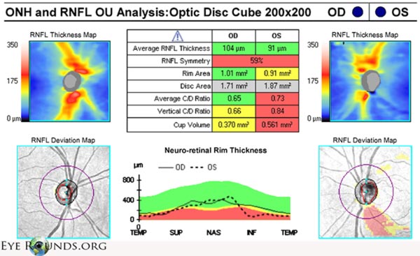 Optic Disc Notch and Retinal Nerve Fiber Layer Defect