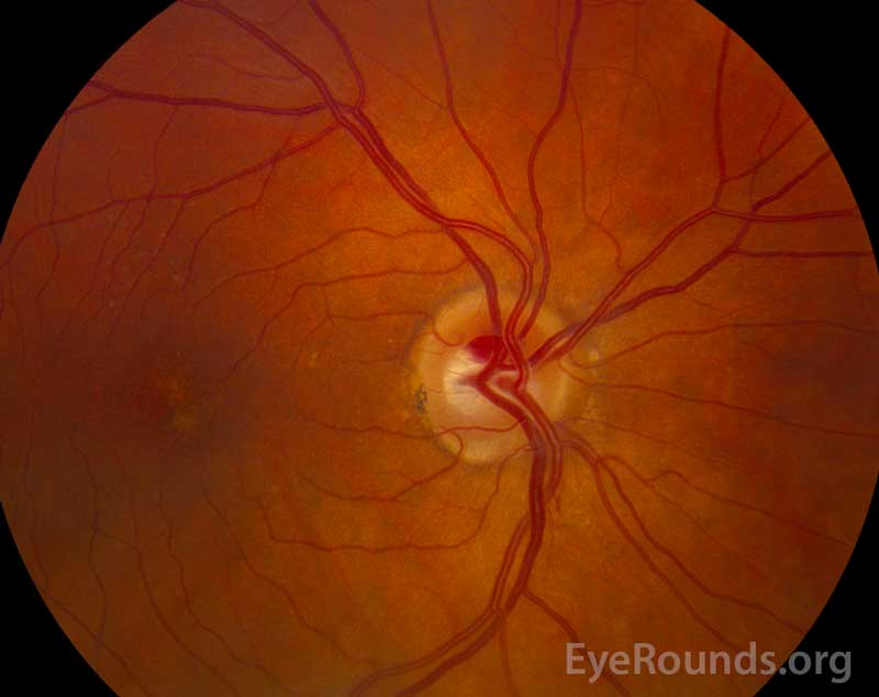 Intrapapillary Hemorrhage