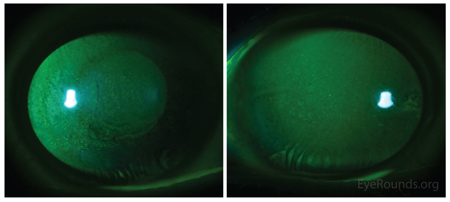 Meesmann Epithelial Corneal Dystrophy