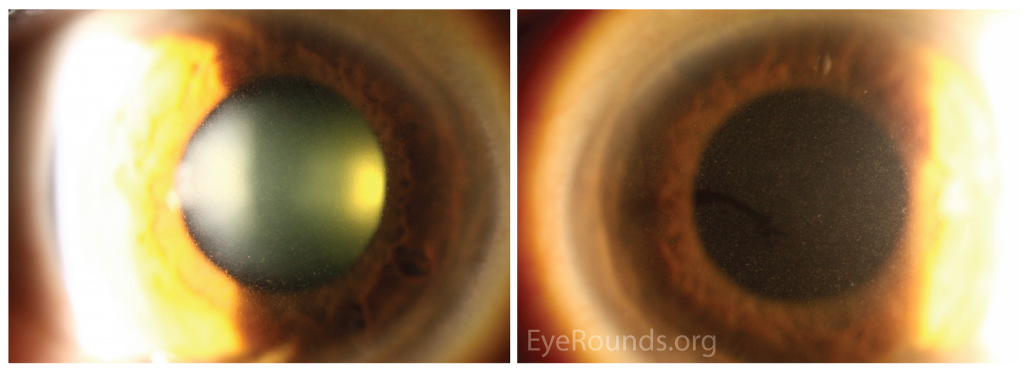 Meesmann Epithelial Corneal Dystrophy