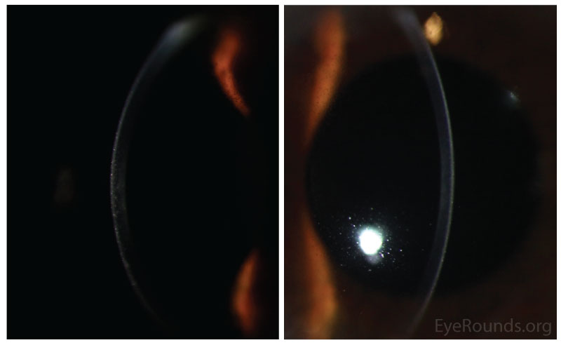 Meesmann Epithelial Corneal Dystrophy