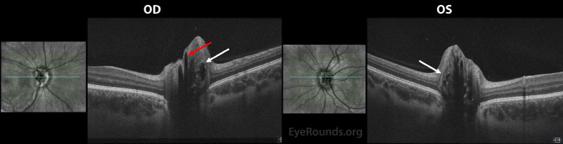 Optic Disc Drusen. EyeRounds.org: Online Ophthalmic Atlas