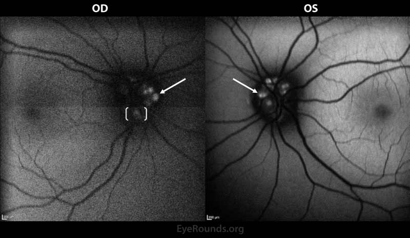 Optic Disc Drusen. EyeRounds.org: Online Ophthalmic Atlas