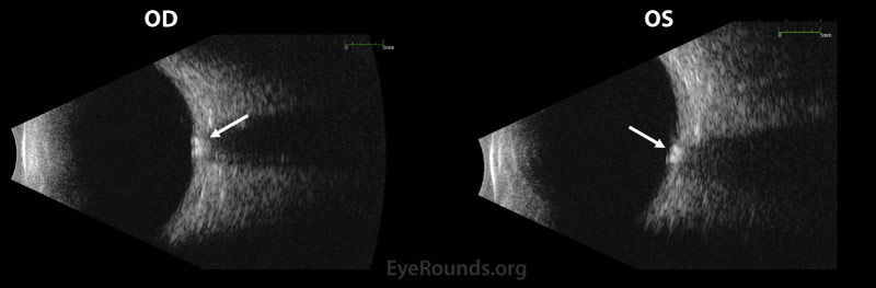 Optic Disc Drusen. EyeRounds.org: Online Ophthalmic Atlas