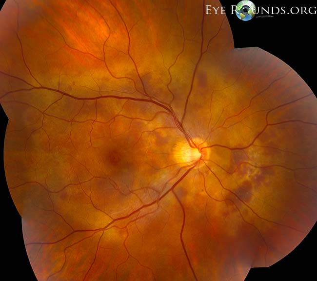Polypoidal choroidal vasculopathy (PCV): The University of Iowa, Ophthalmology